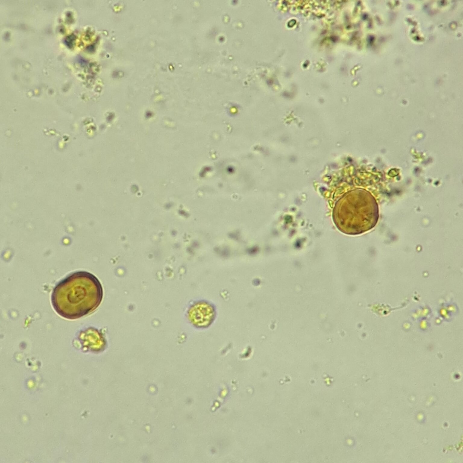 Leucine Crystals: Identification & Clinical Significance