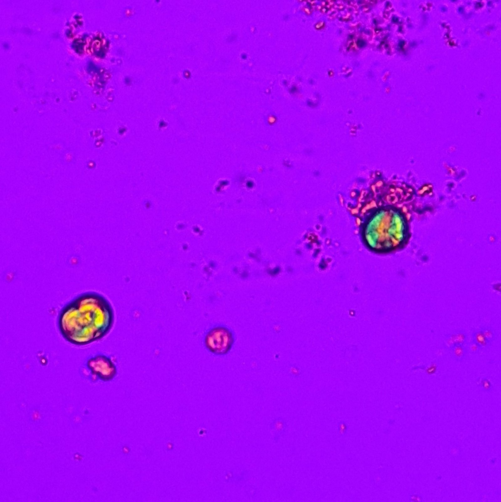 Leucine Crystals: Identification & Clinical Significance