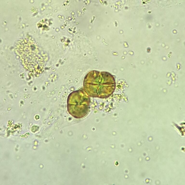 Leucine Crystals: Identification & Clinical Significance