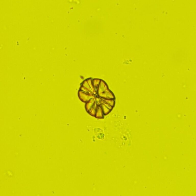 Leucine Crystals: Identification & Clinical Significance