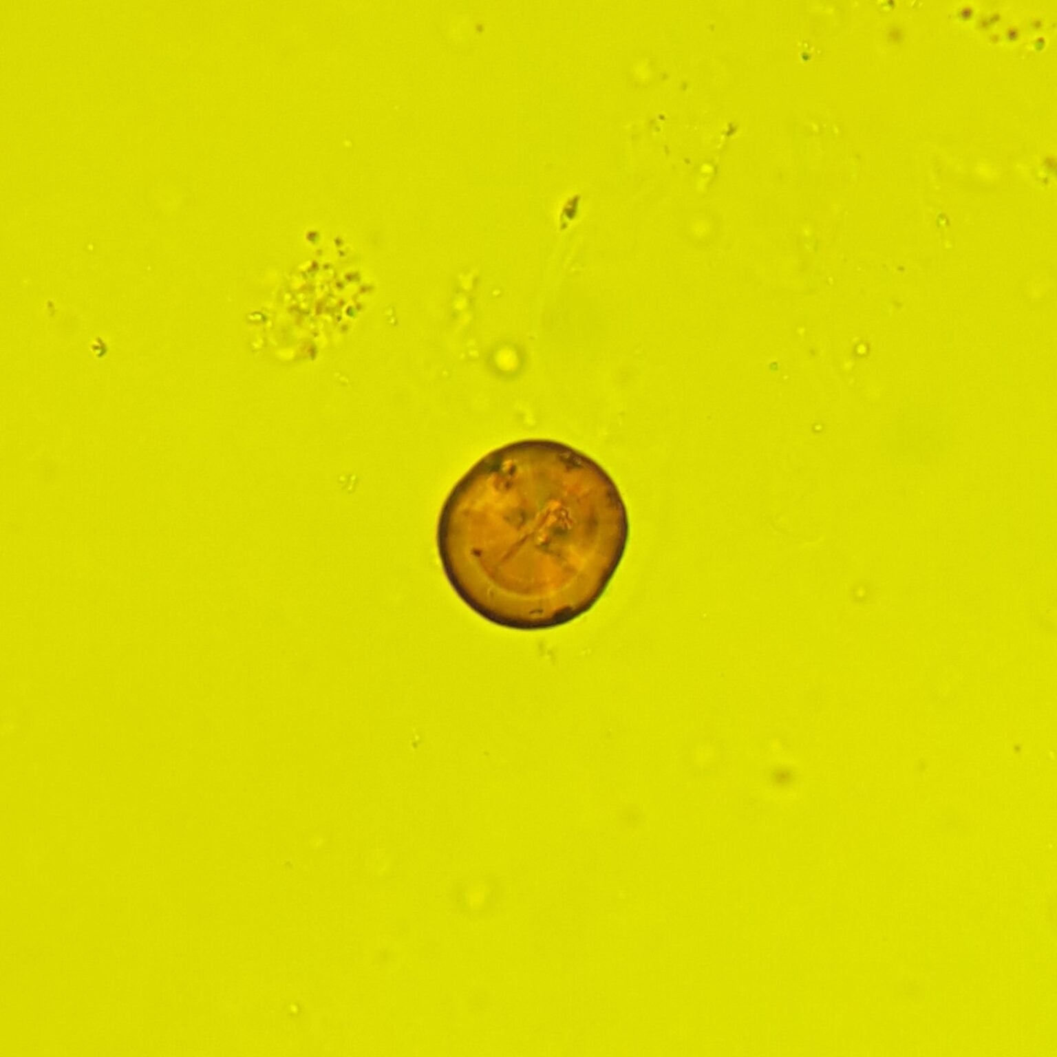 Leucine Crystals: Identification & Clinical Significance
