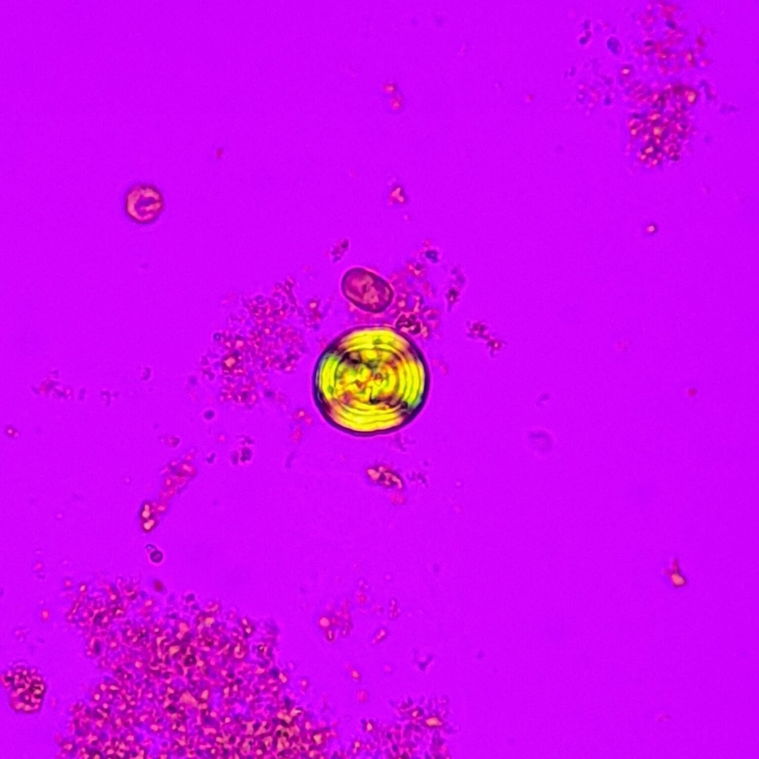 Leucine Crystals: Identification & Clinical Significance