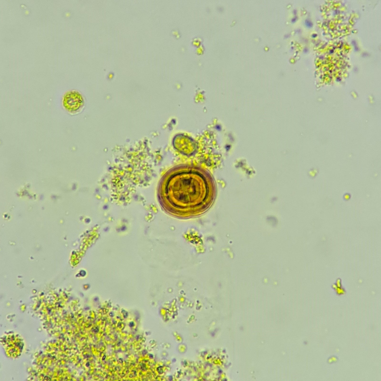 Leucine Crystals: Identification & Clinical Significance