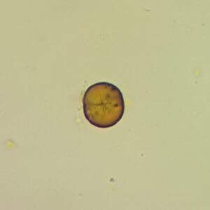 Leucine Crystals: Identification & Clinical Significance