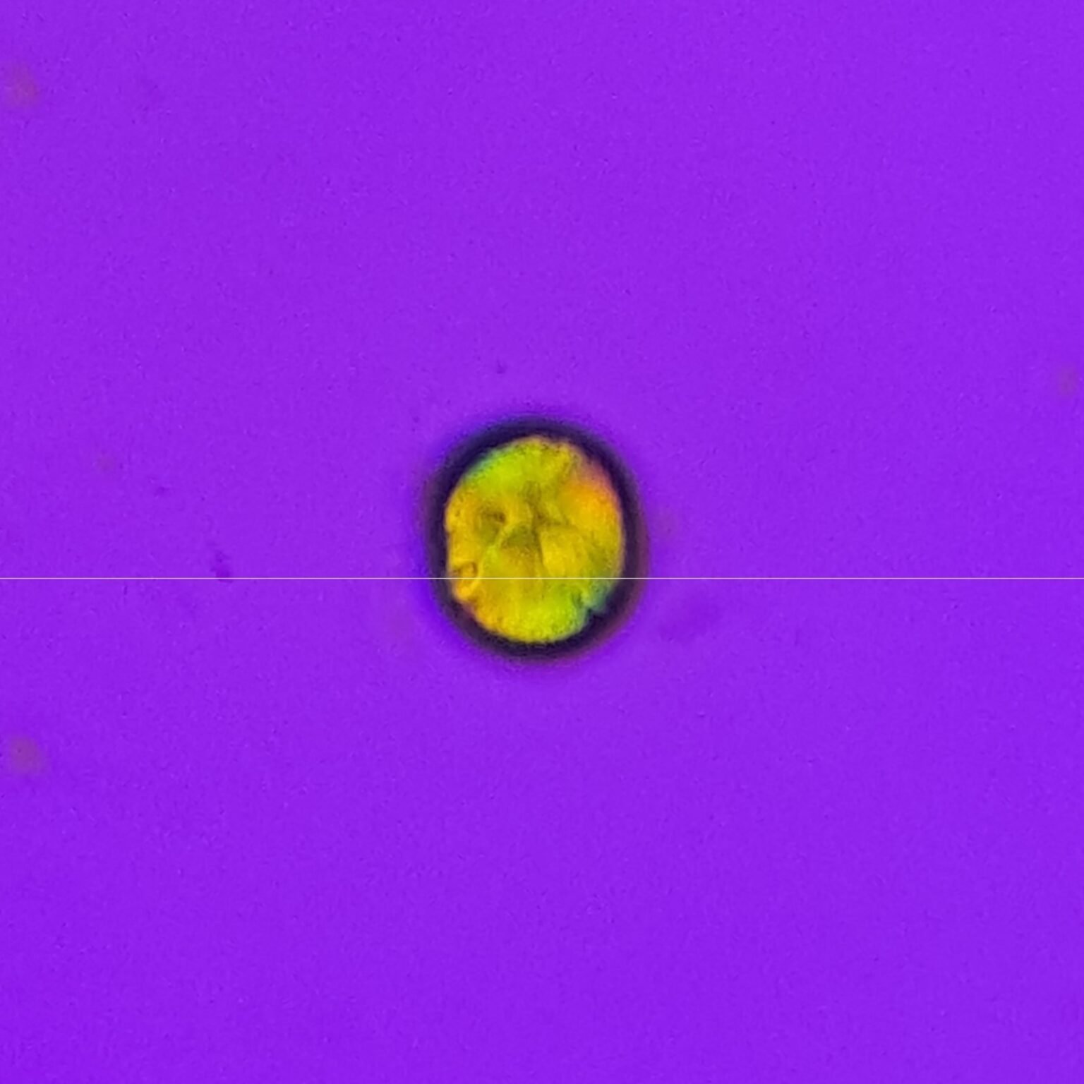 Leucine Crystals: Identification & Clinical Significance