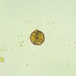 Leucine Crystals: Identification & Clinical Significance