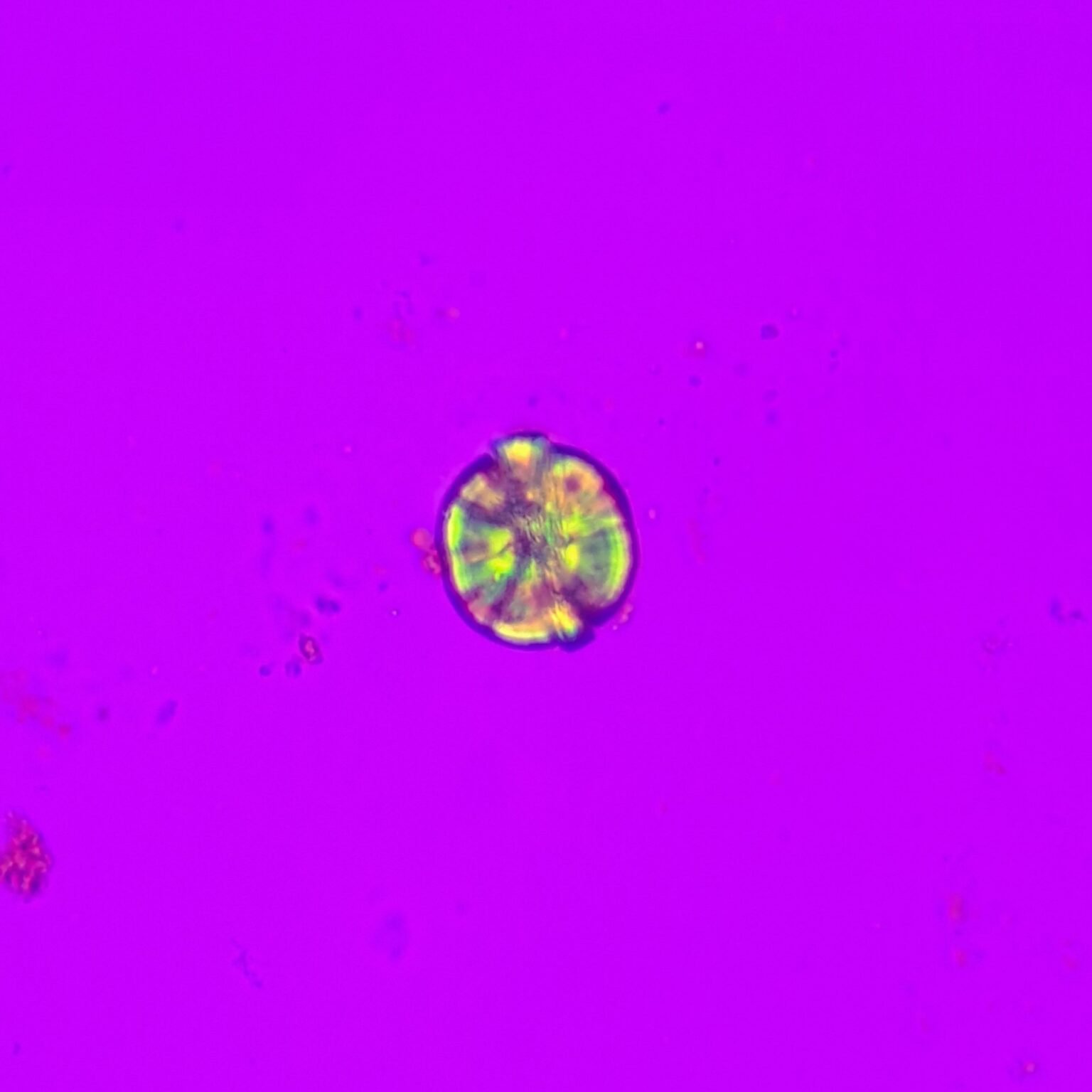 Leucine Crystals: Identification & Clinical Significance