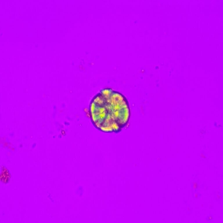 Leucine Crystals: Identification & Clinical Significance