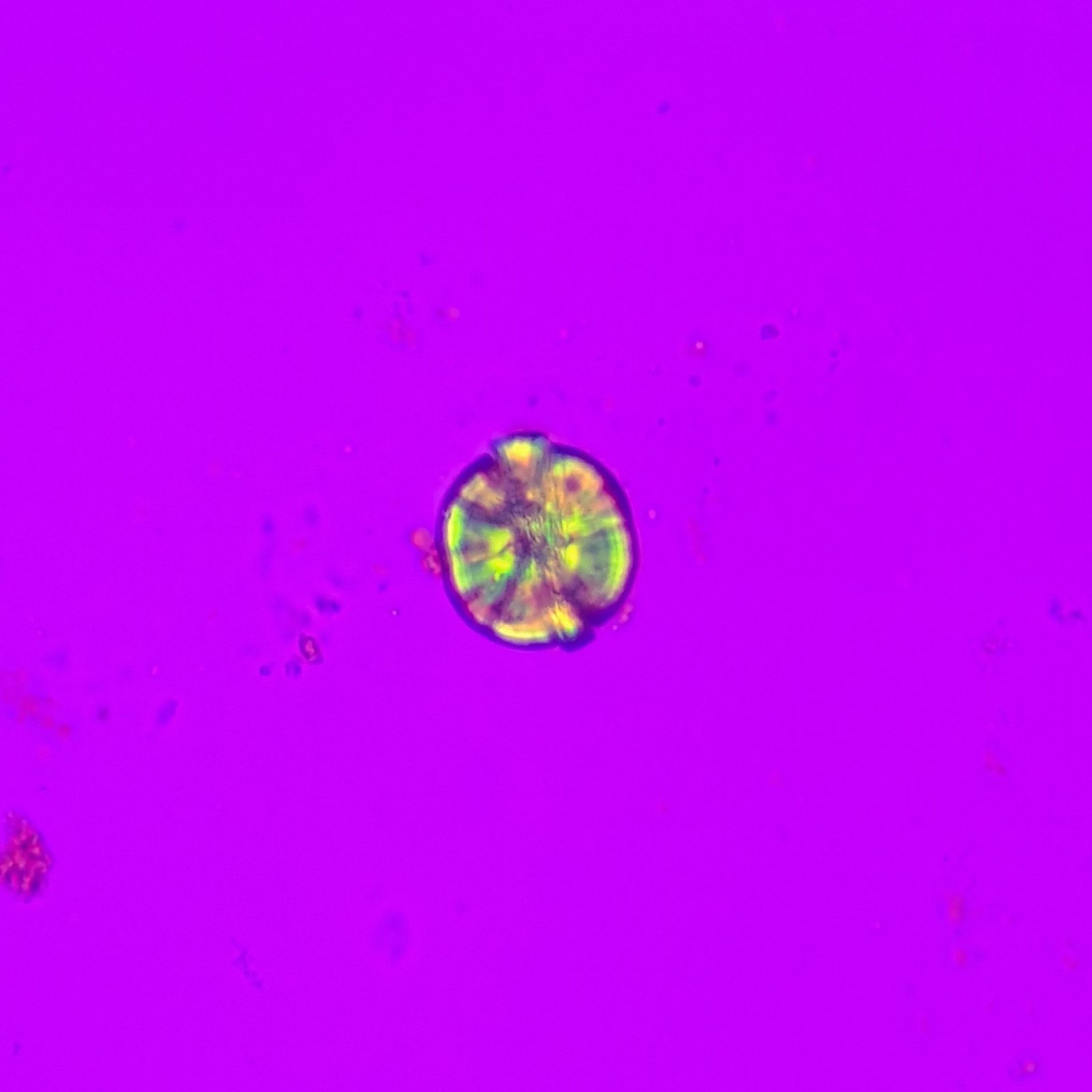 Leucine Crystals: Identification & Clinical Significance