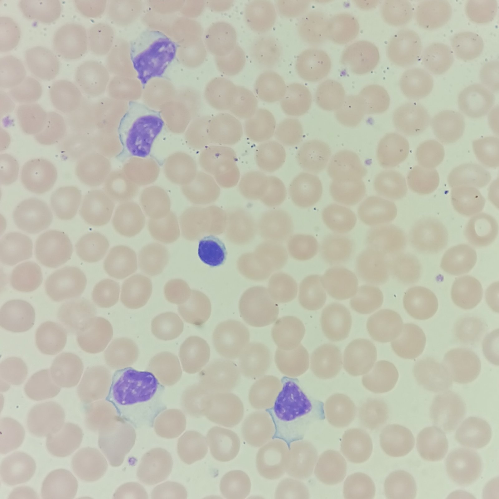 Blast or Activated Lymph? - MedLabBuddy