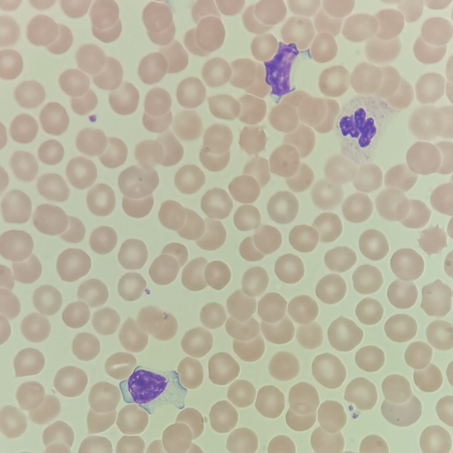 Blast or Activated Lymph? - MedLabBuddy