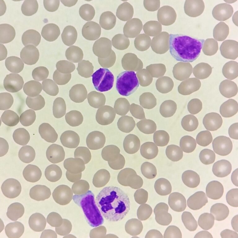 Lymphocytes: Normal & Atypical