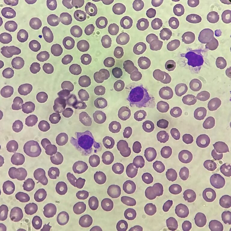 Smudge Cells: Identification & Differentiation