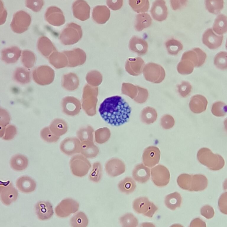 Smudge Cells: Identification & Differentiation