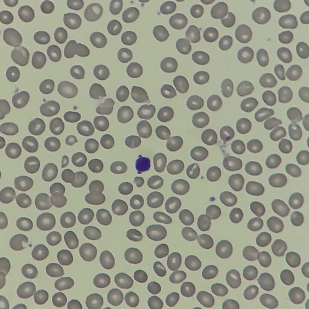 RBC Morphology Based on Indices