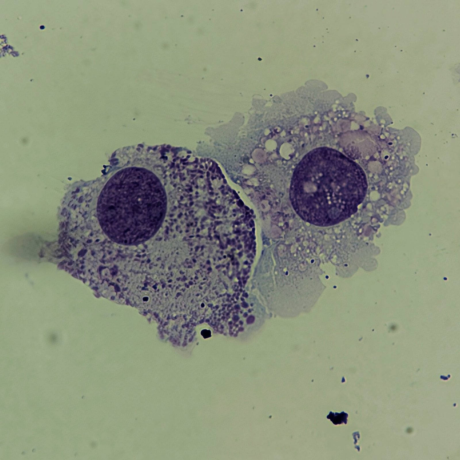 Body Fluid Monocytes / Macrophages - MedLabBuddy