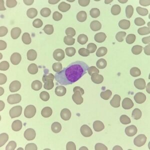 Blast Cells: Identification & Differentiation