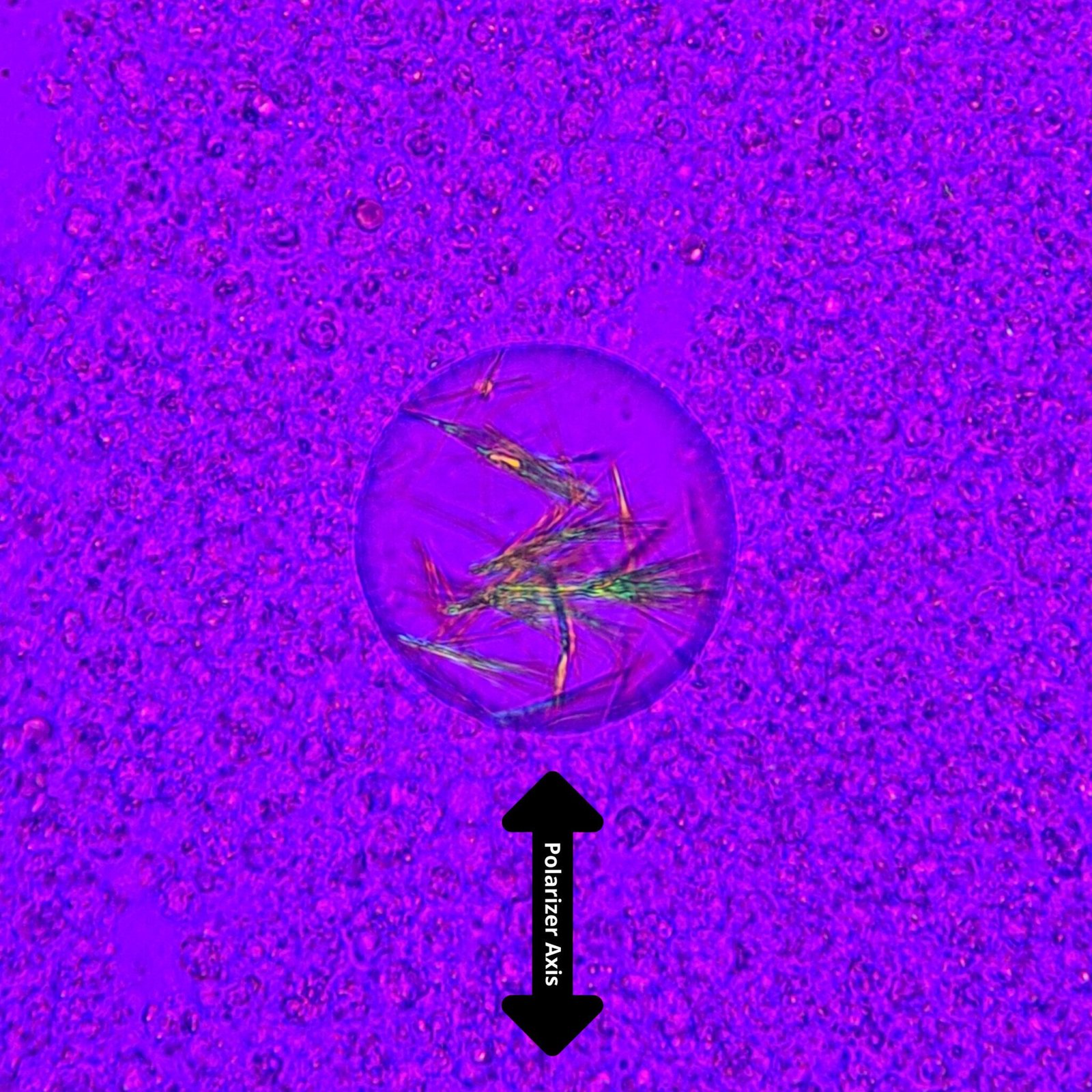 Gout Crystals: Identification & Differentiation