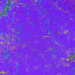 Body Fluid Crystals: Identification and Clinical Significance