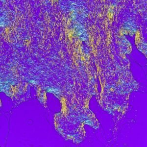 Body Fluid Crystals: Identification and Clinical Significance