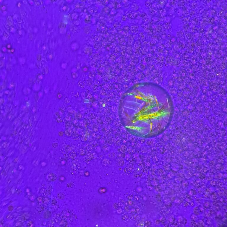 Body Fluid Crystals: Identification and Clinical Significance