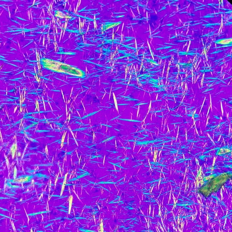 Gout Crystals: Identification & Differentiation