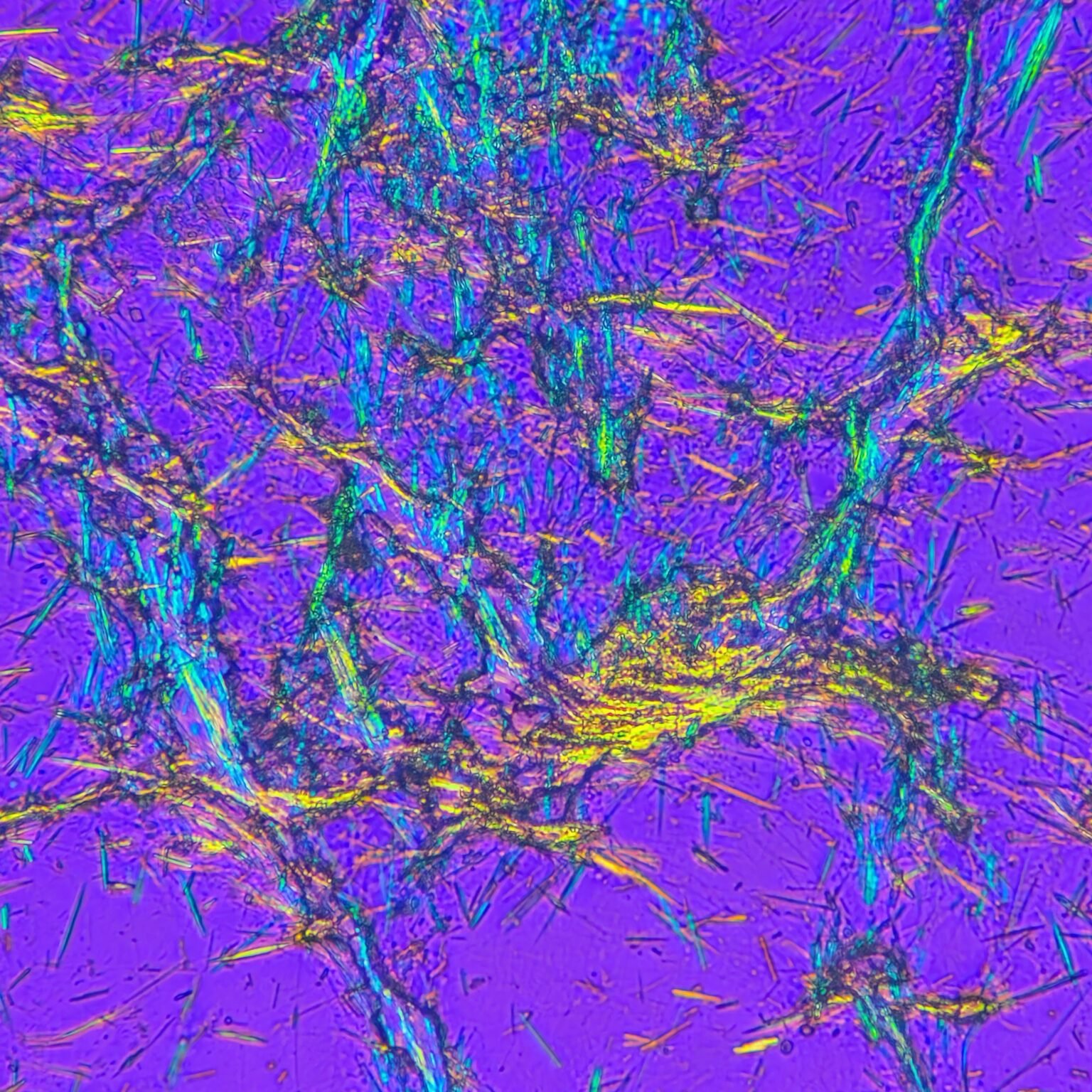 Body Fluid Crystals: Identification and Clinical Significance