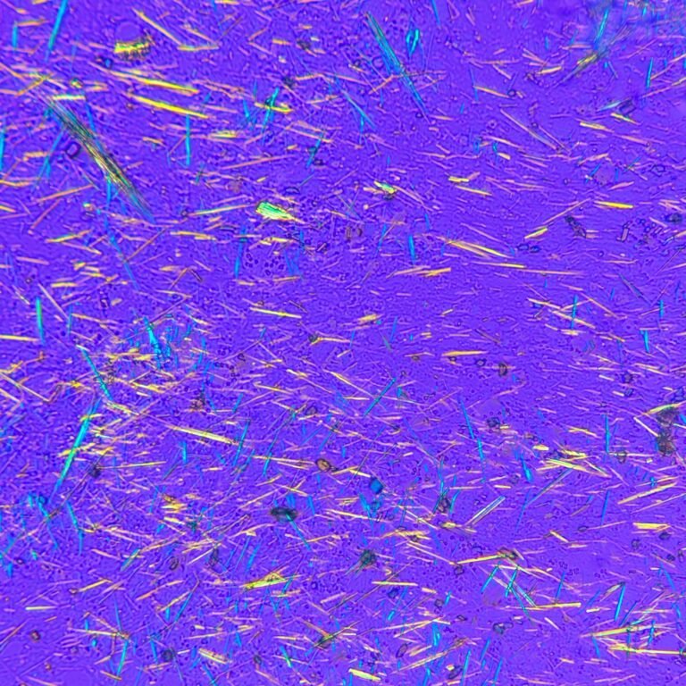 Body Fluid Crystals: Identification and Clinical Significance