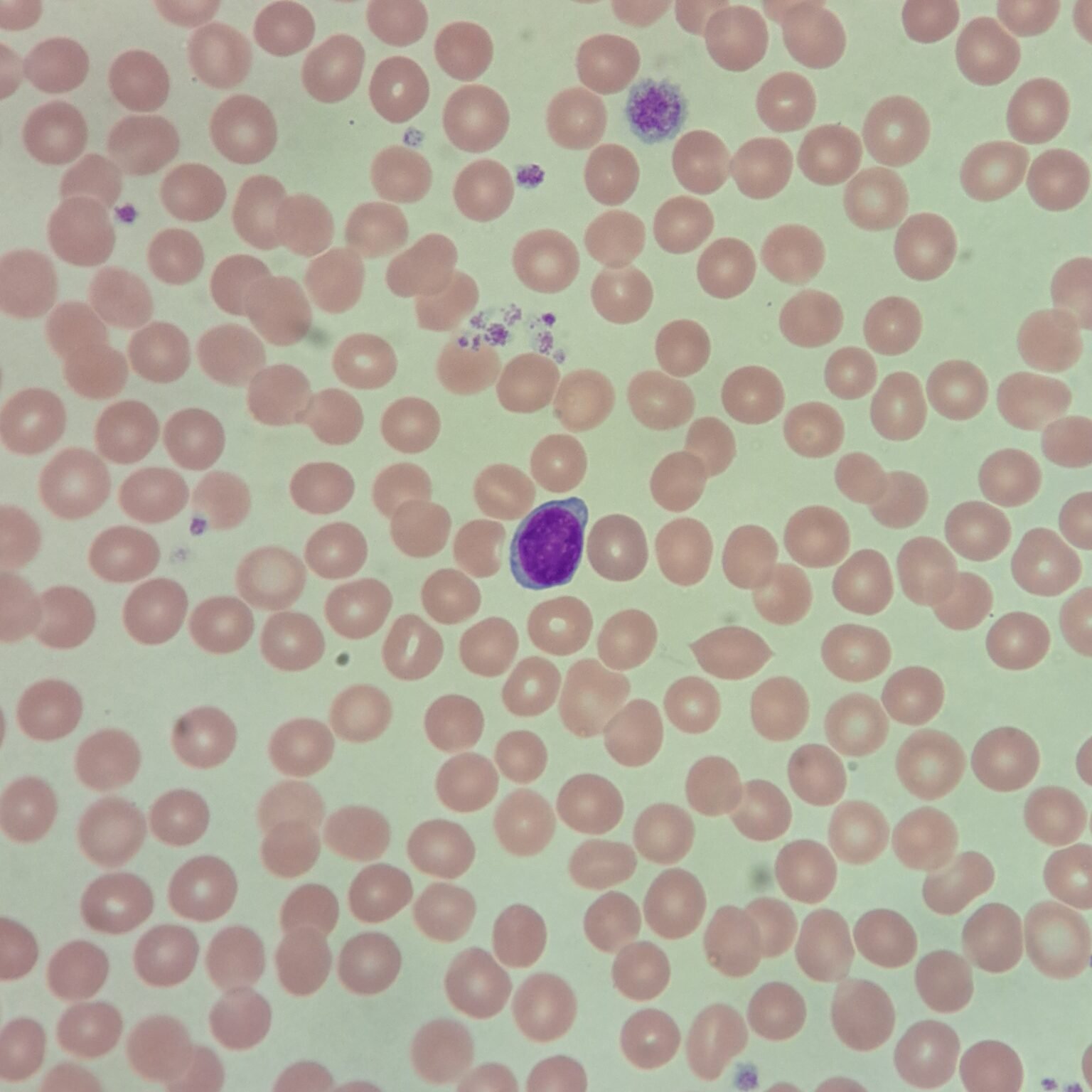 RBC Morphology Based on Indices