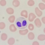 Neutrophil Inclusions & Abnormalities