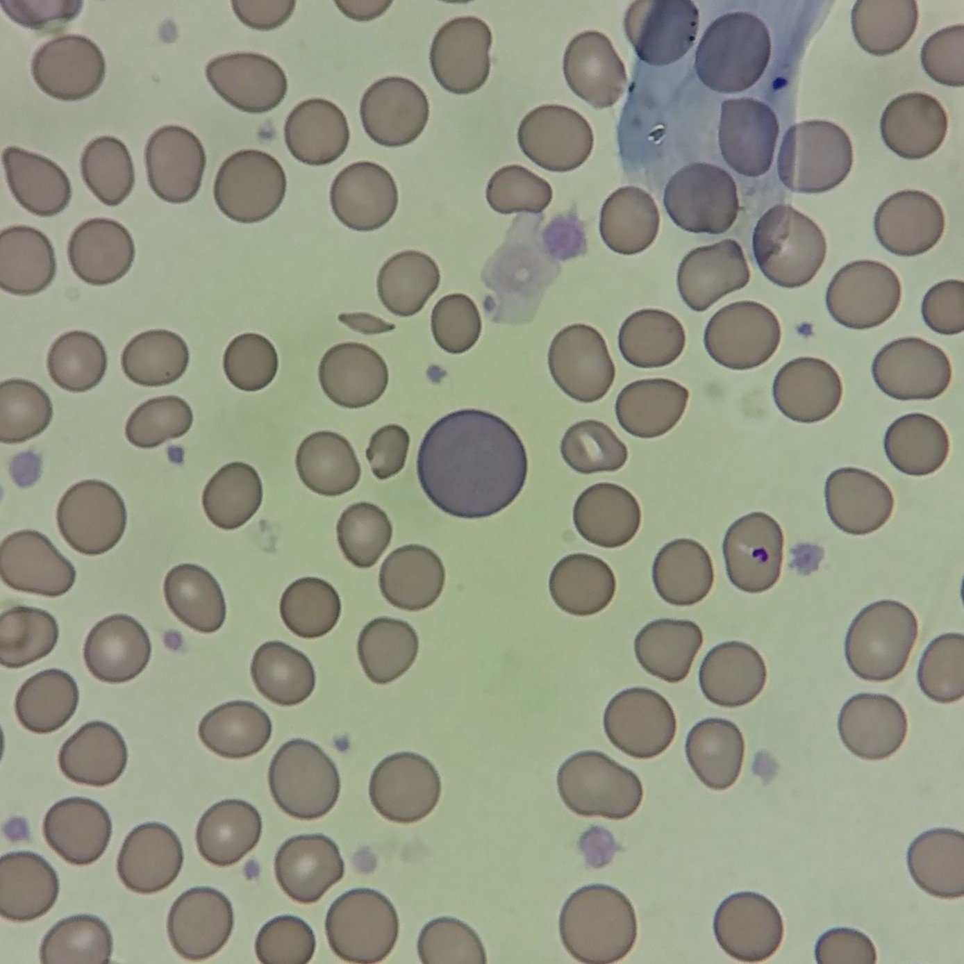 Polychromasia - MedLabBuddy
