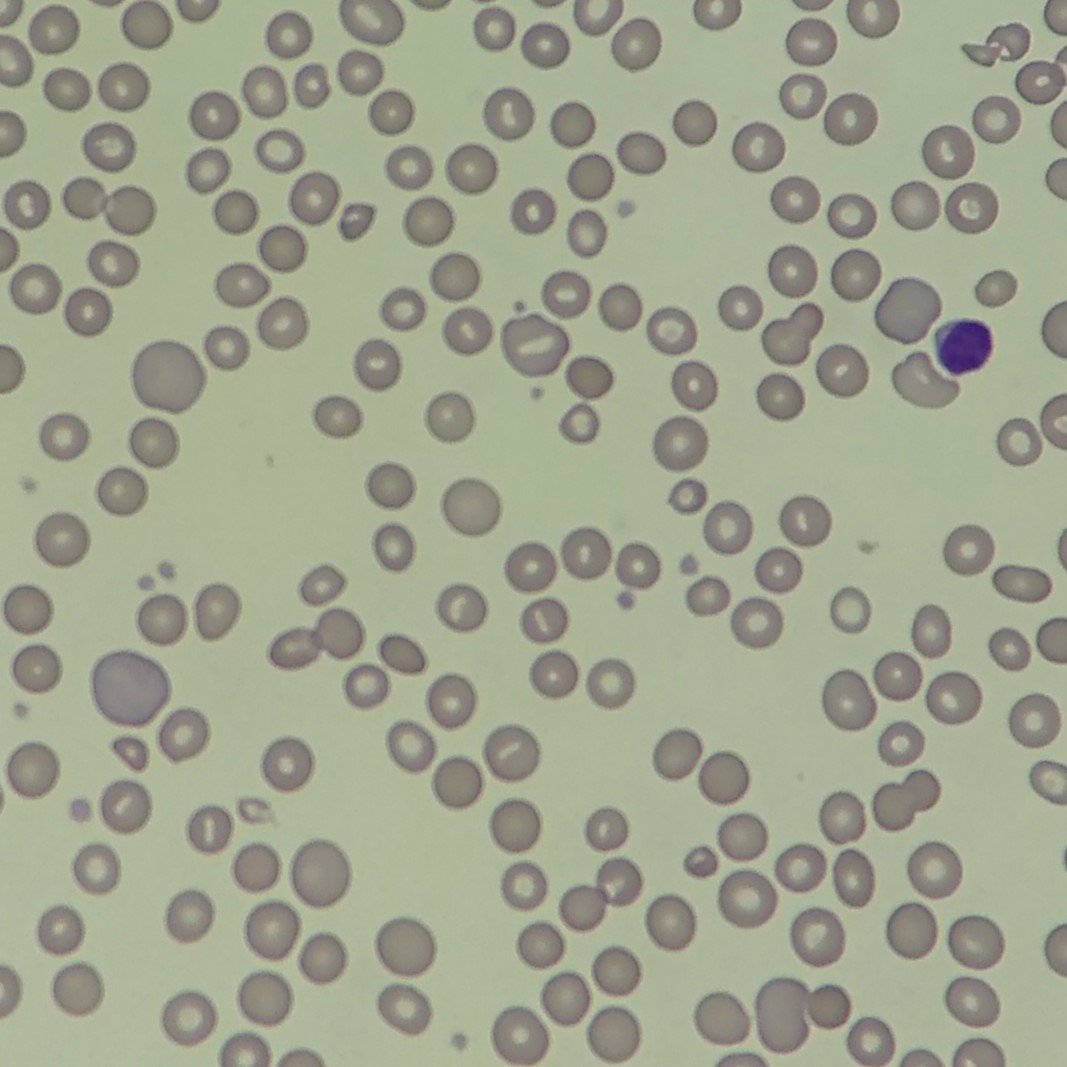 Polychromasia - MedLabBuddy