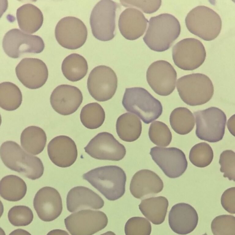 Polychromasia - MedLabBuddy
