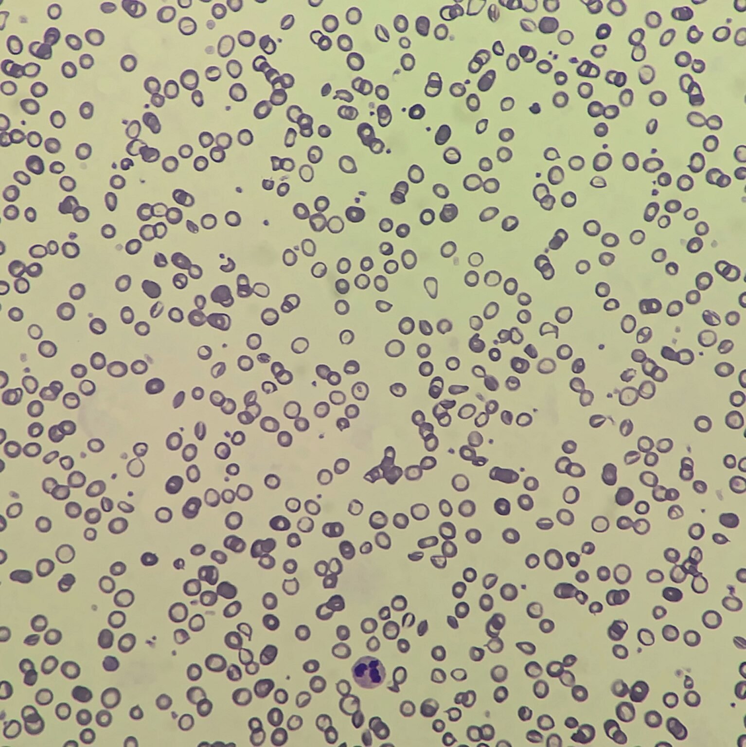RBC Morphology Based on Indices