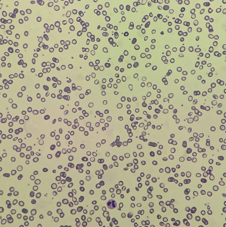 RBC Morphology Based on Indices