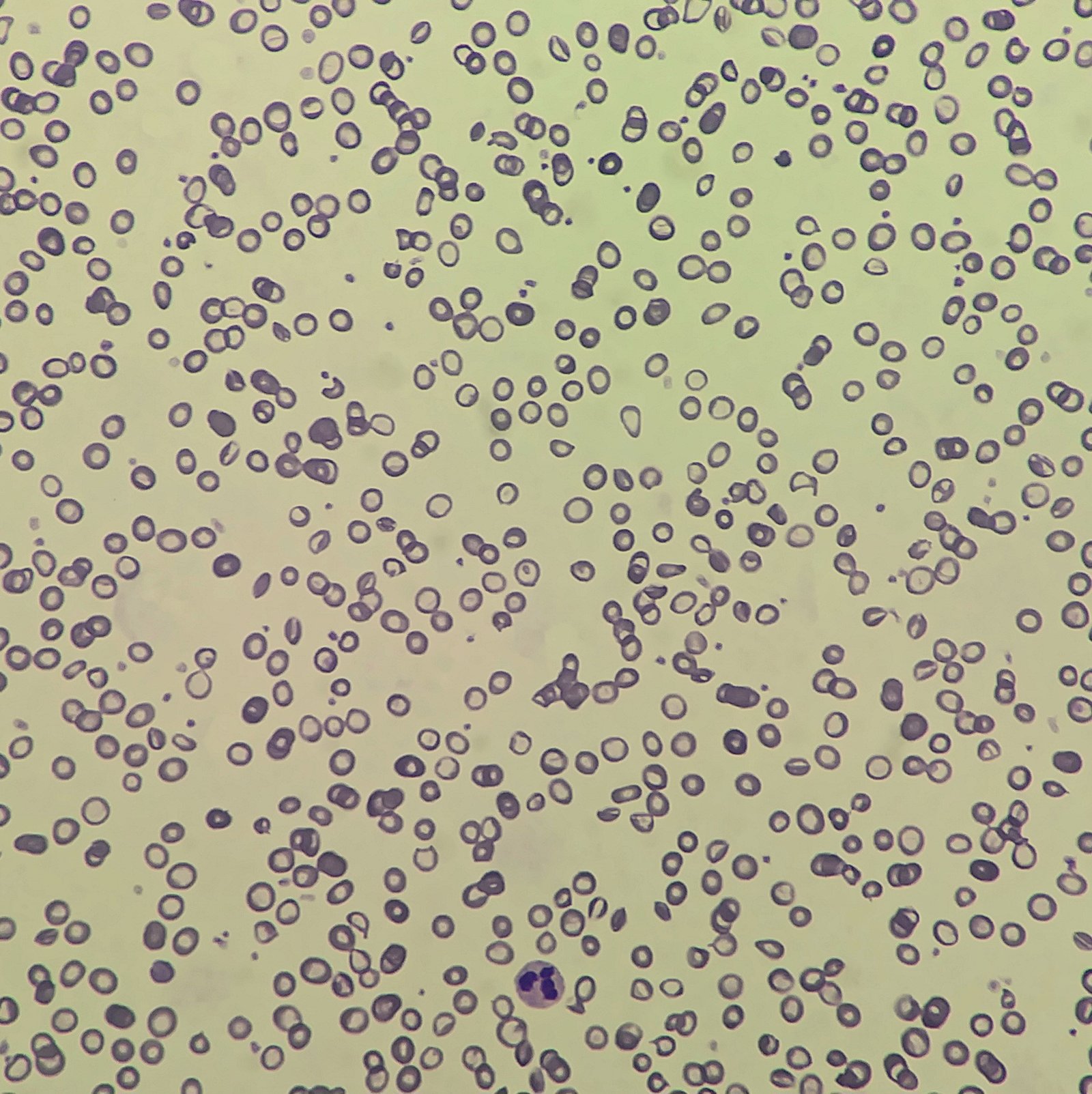 RBC Morphology Based on Indices