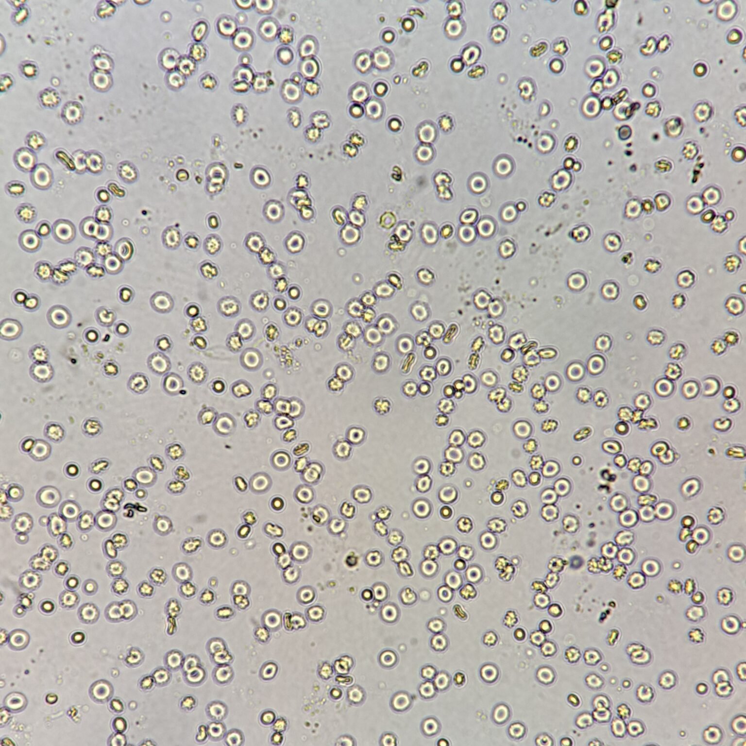 RBCs in Urine & Their Lookalikes - MedLabBuddy