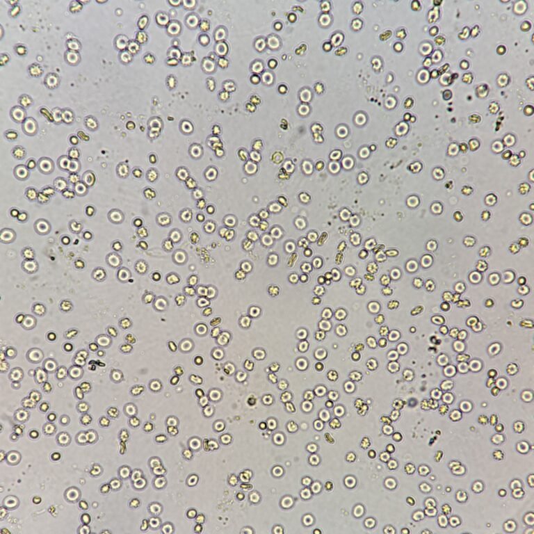 Urinary Casts: Identification & Significance