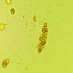 Renal Tubular Epithelial Cell Casts: Identification & Significance ...