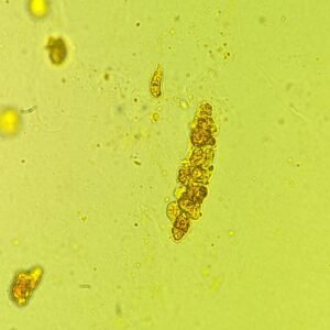 Renal Tubular Epithelial Cell Casts: Identification & Significance ...