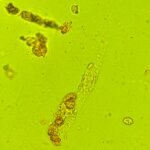 Renal Tubular Epithelial Cell Casts: Identification & Significance ...