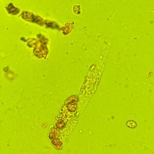 Renal Tubular Epithelial Cell Casts: Identification & Significance ...