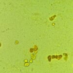 Renal Tubular Epithelial Cell Casts: Identification & Significance ...