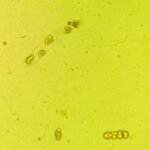 Renal Tubular Epithelial Cell Casts: Identification & Significance ...