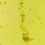 Renal Tubular Epithelial Cell Casts: Identification & Significance ...