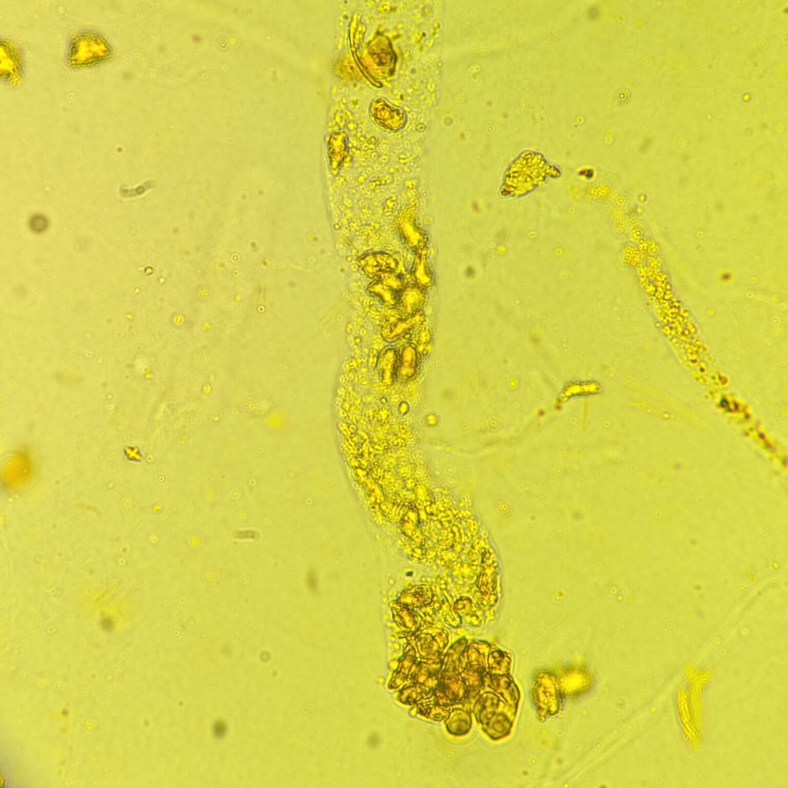 Renal Tubular Epithelial Cell Casts: Identification & Significance ...