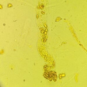 Renal Tubular Epithelial Cell Casts: Identification & Significance ...