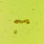 Renal Tubular Epithelial Cell Casts: Identification & Significance ...