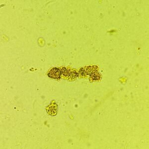 Renal Tubular Epithelial Cell Casts: Identification & Significance ...