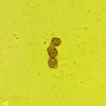 Renal Tubular Epithelial Cell Casts: Identification & Significance ...
